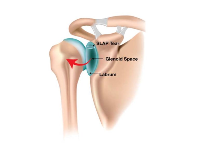 Weight Room Exercise Modifications for the Post-Rehabilitated Athletic ...